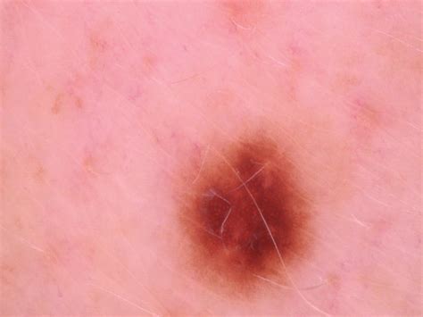 Ham10000 Instance Segmentation Instance Segmentation Dataset By Epics Ham10000