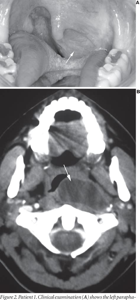 Cysts Of The Fossa Of Rosenmüller Report Of Two Cases Semantic Scholar