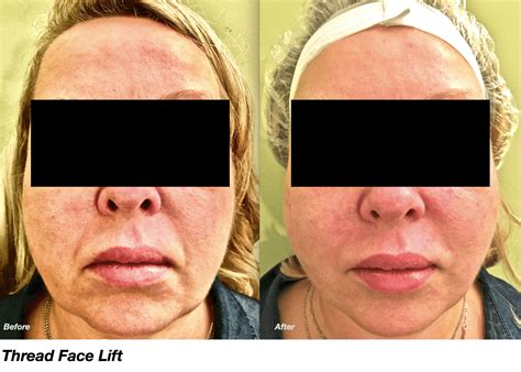 Thread Lift In Vancouver Neck Face And Eyebrow Dr Mazanderani Dr