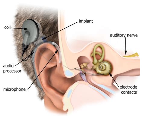 Machine Learning And Cochlear Implantation Predicting The Post