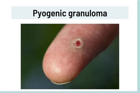Comparing Skin Growths Pyogenic Granuloma And Cherry Angioma Sydt