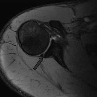 Probing Of A Posterior Labral Tear Of The Left Shoulder As Seen From