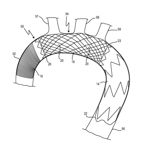 Intraluminal Vascular Prosthesis Eureka Patsnap