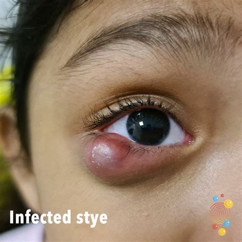 Lower Eyelid Infection