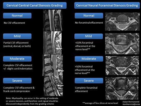 Qualitative Grading Of Severity Of Lumbar Spinal Stenosis At Lilly