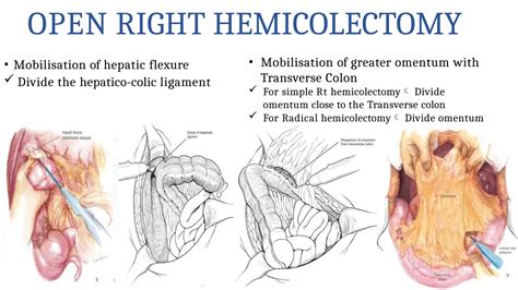 Open Right Hemicolectomy General Surgery Coursepptx