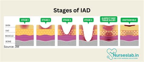 What Is Incontinence Associated Dermatitisiad How To Manage It