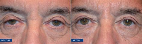 Oculoplastic Surgery Before And After Gallery Eye Care Associates Of