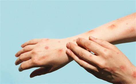 Study Describes Monkeypox In Women Cdc Warns Of Tpoxx Resistance Cidrap