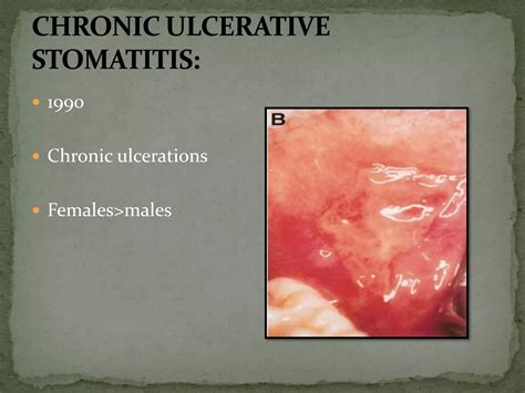 Desquamative Gingivitis Pptx