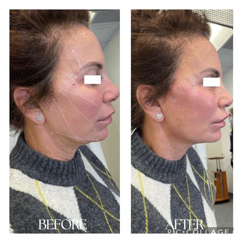 Pdo Threads Body And Face New Medical Spa