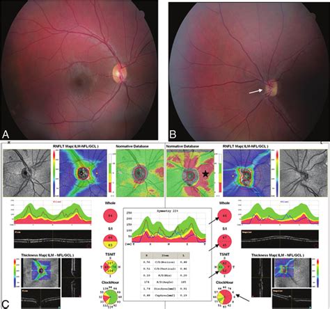 Fundus Photography Of Right A And Left B Eyes The Optic Disc Is