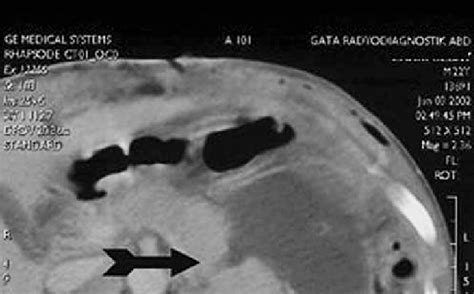 Missed Pancreatic Transection And Infected Pseudocyst Formation 3 Weeks