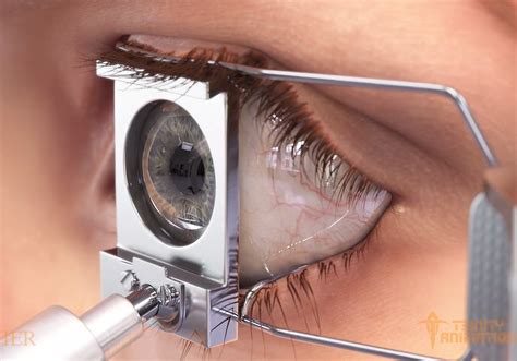 Метод Lasik