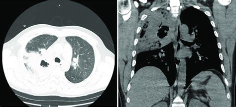 Chest Ct Without Contrast Showing Right Upper Lobe Cystic Cavitation
