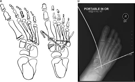 Combined Medial Cuneiform Osteotomy And Multiple Metatarsal