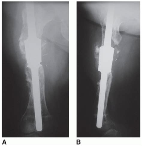 Megaprosthesis After Tumor Resection Musculoskeletal Key