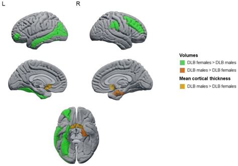 Sex Differences In Brain Atrophy In Dementia With Lewy Bodies Abstract Europe Pmc