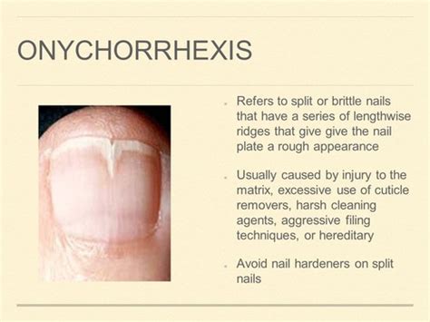 Onychorrhexis