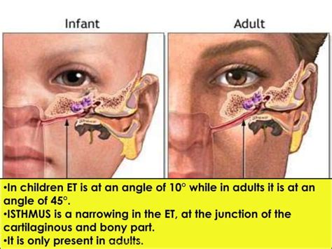 Acute Suppurative Otitis Media Pptx Ear Nose And Throat Conditions