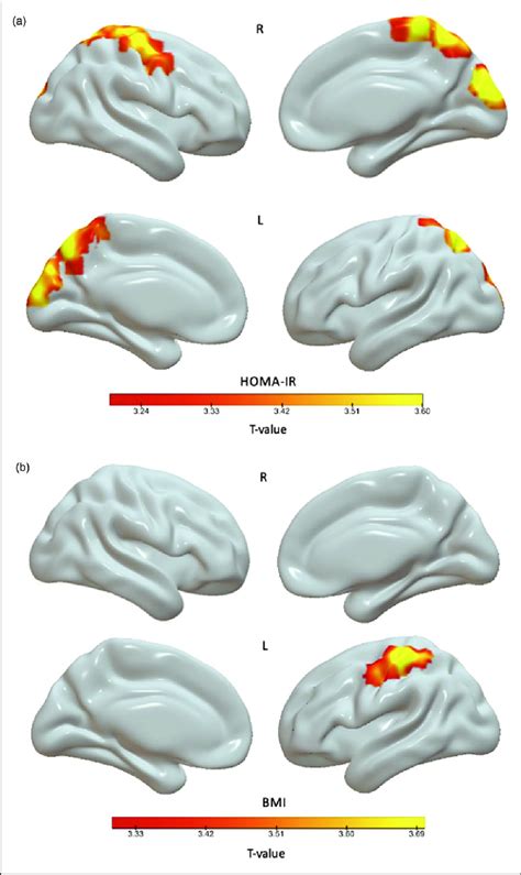 Voxel Wise Regression Analysis Of The Association Between 11