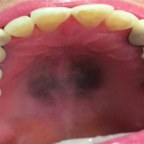 What Is A Hard Palate Lesion At Alan Koester Blog