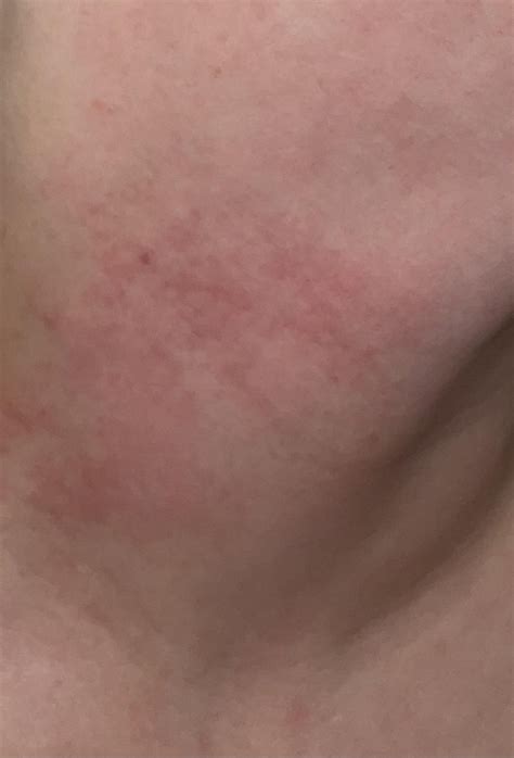 Constant Recurring Skin Rash Flare Ups R Dermatologyquestions