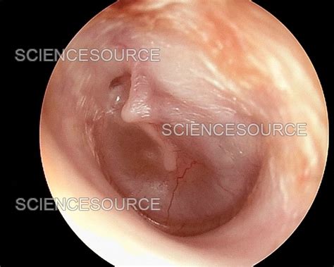 Otitis Externa Otoscope