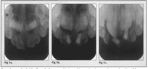 Pulpectomy Treatment Of Choice For Necrotic Primary Molars Compared To