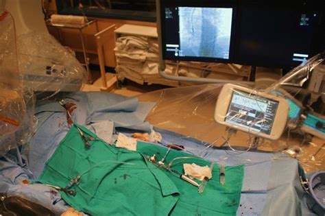 When And How To Perform A Transradial Approach For Cto Pci Thoracic Key