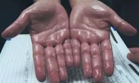 Needle Free Botulinum Toxin Injections A Less Painful And Effective