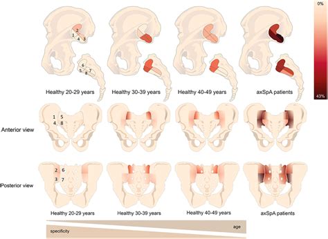 heatmaps showing bone marrow edema detected by magnetic resonance download scientific diagram