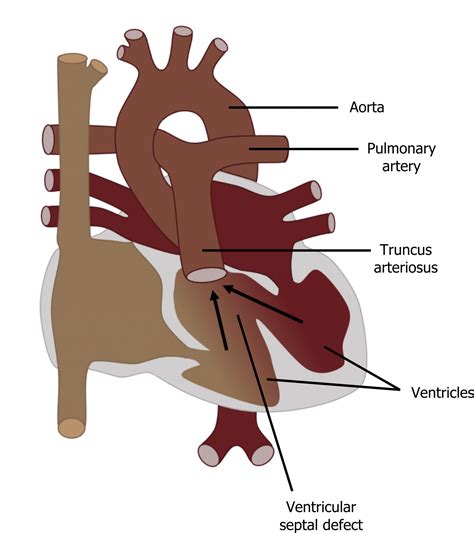 Congenital Heart Disease Cardiovascular Pathophysiology For Pre