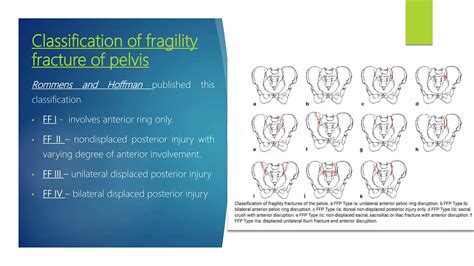 Pelvis Fracture Dislocation Pptx Pelvis Fracture Dislocation Pptx