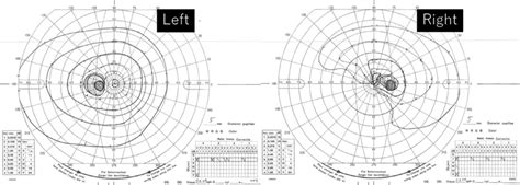 Perimetry Of The Patient Shows Right Sided Inferonasal Quadrantanopia