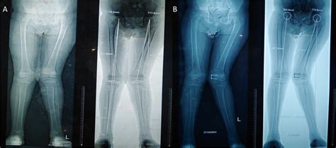 Standing X Rays Of Bilateral Tibia Femora And Pelvic Bones Ap View