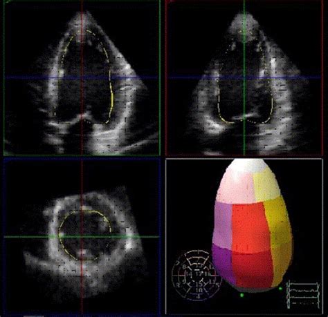 Accuracy And Feasibility Of Online 3 Dimensional Echocardiography For Measurement Of Left