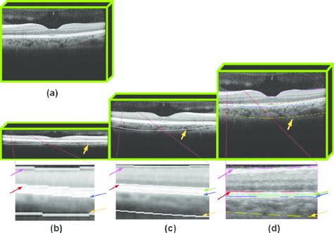 Example Illustration Of The Multistage Layer Segmentation In A B Scan Download Scientific