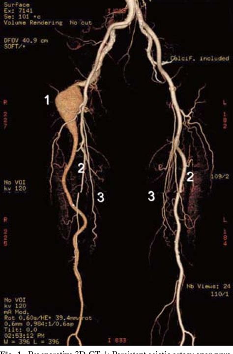 Table 1 From A Case Of Persistent Sciatic Artery Aneurysm Accompanied