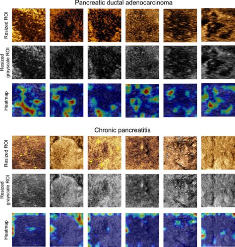 examples of heatmaps generated by our dlr model for pdac and cp