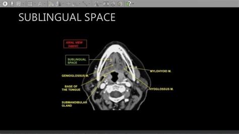 Ct Anatomy Of Neck Spaces Rv