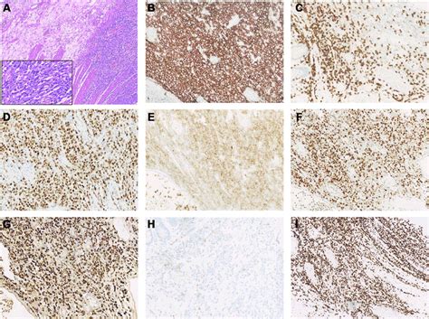 Immunohistochemical Staining Of Diffuse Large B Cell Lymphoma Tissue Download Scientific