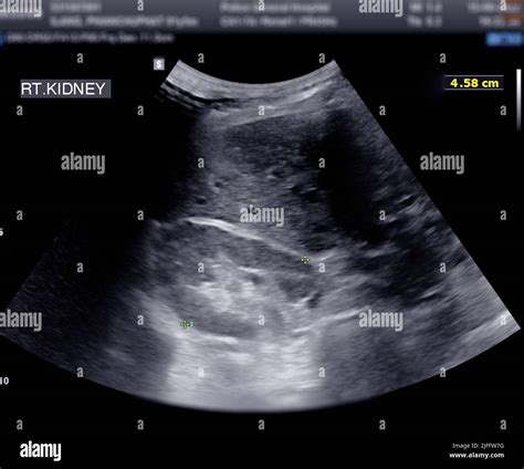 Abnormal Bladder Ultrasound