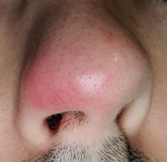 Mrsa Inside Nares