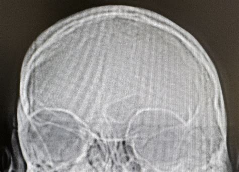 Frntal Sinus Underdevelopment And Metopic Suture Plain Skull X Rays Dr Barry Eppley Explore