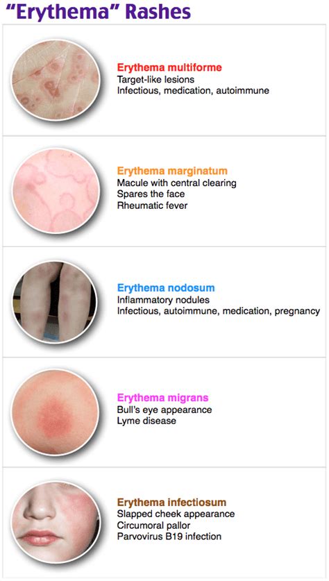 Image Of The Week Erythema Rashes Artofit