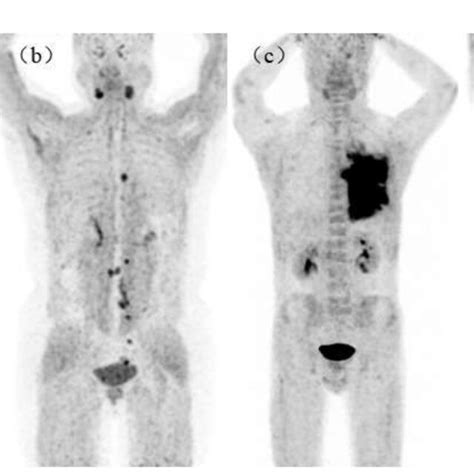 Figure E Maximum Intensity Projections Mips In Patients With Lung Download Scientific Diagram