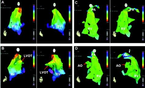 Teaching Points With 3 Dimensional Mapping Of Cardiac Arrhythmias