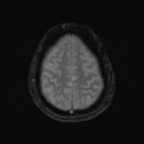Radiopaedia Case Complicated Brainstem Cavernoma And Developmental