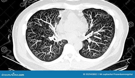 Ct Chest Scan Overview Shows Clear Lung Fields Heart And Mediastinum